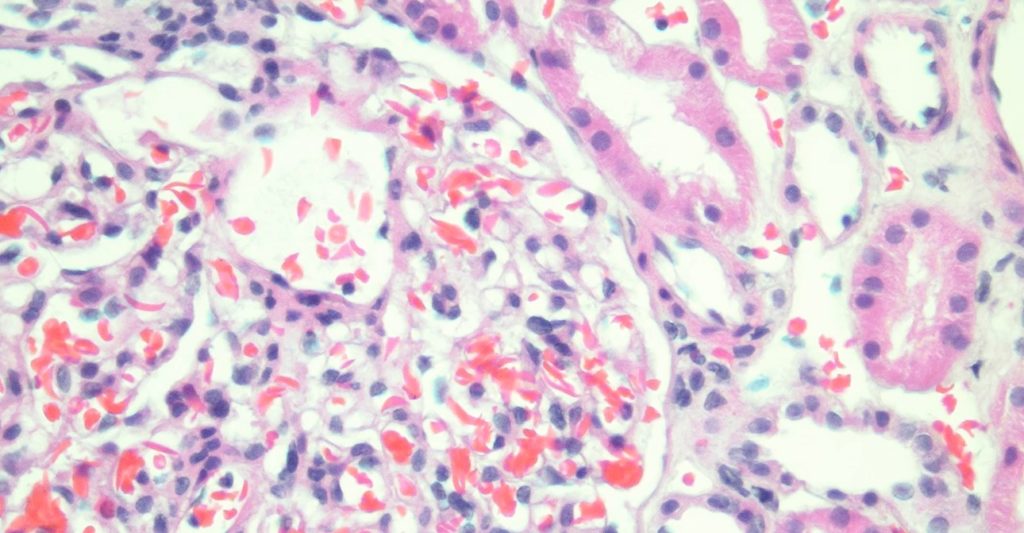 Kidney-CY Case 6 | www.shameempathology.com