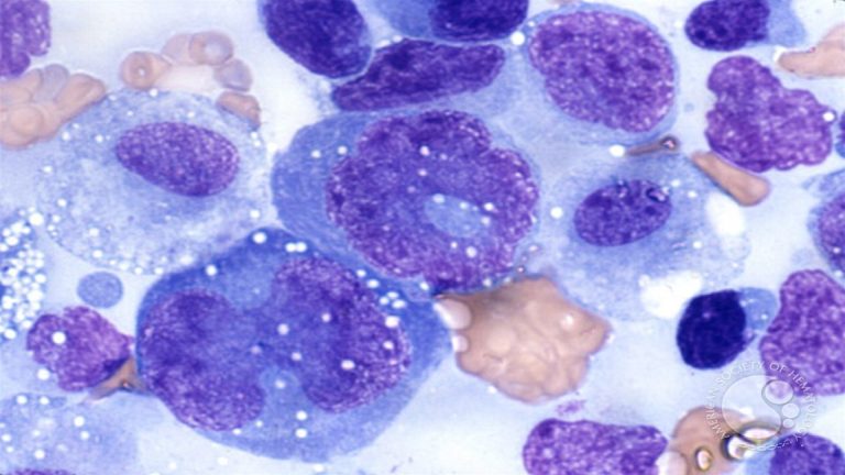 Mantle cell lymphoma – etiopathogenesis, morphology | www ...